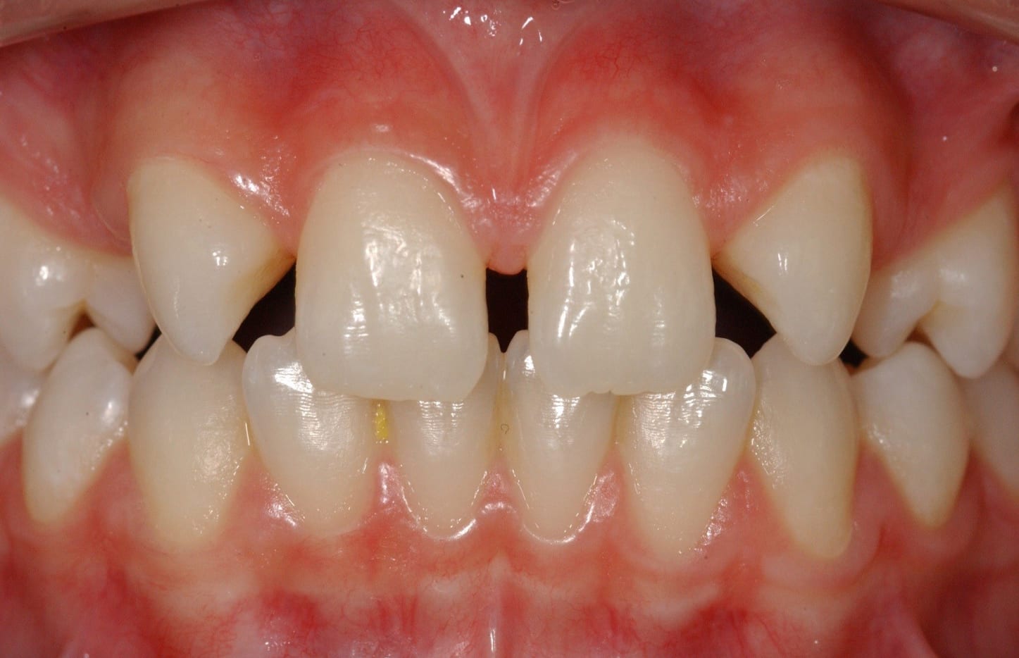 Missing Teeth Forbes Orthodontics Missing Teeth Forbes Orthodontics