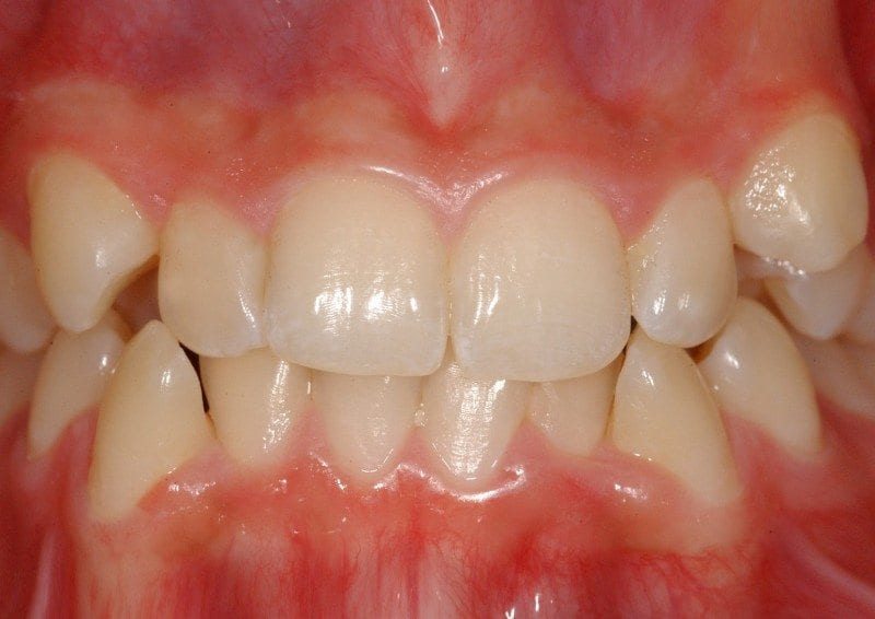 The Transition from Baby Teeth to Adult Teeth - Forbes Orthodontics