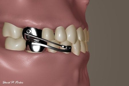 The Herbst Appliance - Forbes Orthodontics