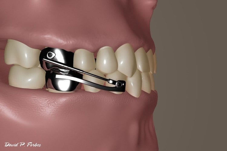 The Herbst Appliance - Forbes Orthodontics