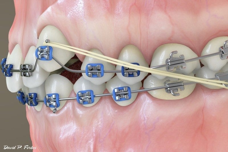Orthodontic Tooth Movement - Forbes Orthodontics