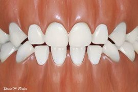 The Transition From Baby Teeth To Adult Teeth Forbes Orthodontics